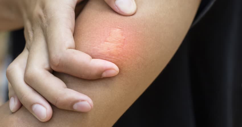 Allergie agli insetti: guida completa per riconoscerle e gestirle