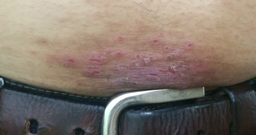 Allergia al nichel: sintomi, cause e gestione
