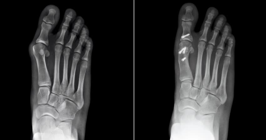 Alluce valgo: quando è necessario l’intervento chirurgico?