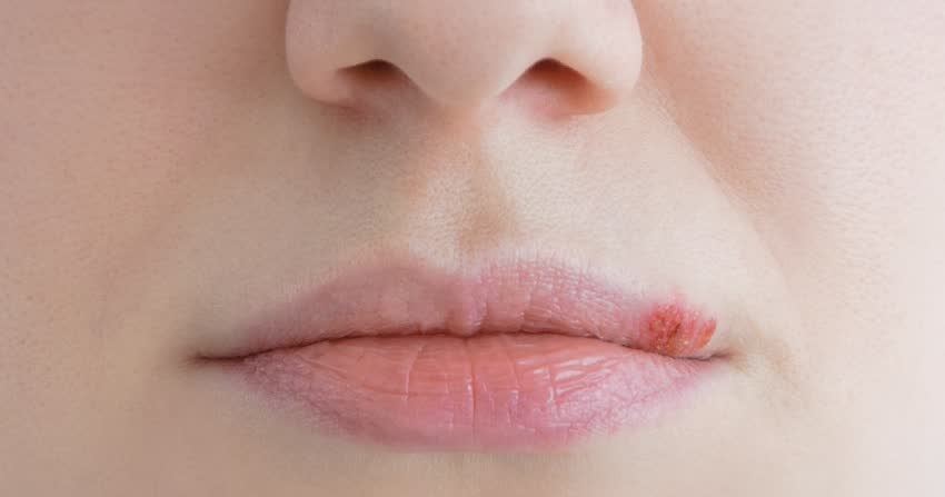 Combattere l'herpes labiale: farmaci, rimedi naturali e prevenzione