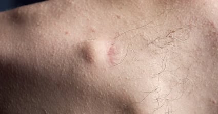 Lipoma: guida completa su intervento chirurgico e recupero