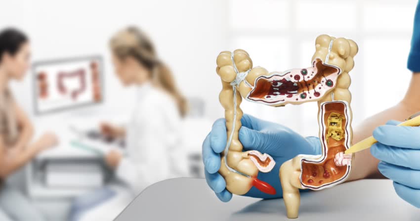 Conoscere i polipi intestinali: dai fattori di rischio al trattamento