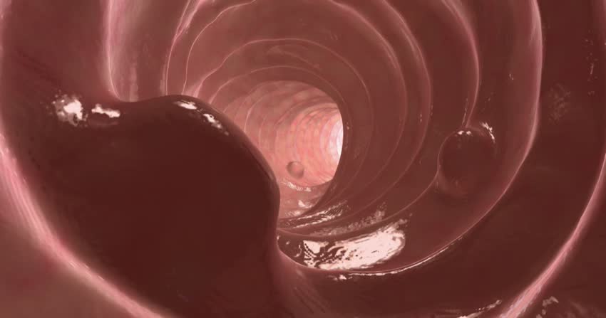 Conoscere i polipi intestinali: dai fattori di rischio al trattamento
