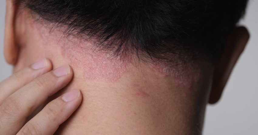 Psoriasi del cuoio capelluto: cause, sintomi e rimedi