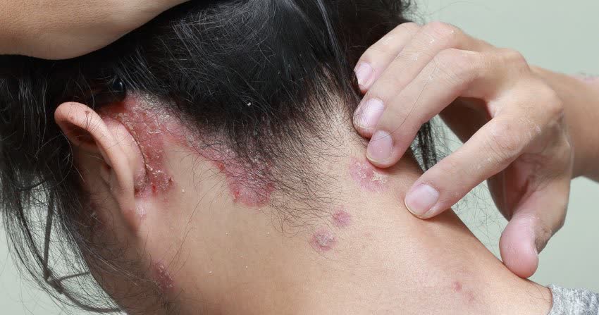 Psoriasi del cuoio capelluto: cause, sintomi e rimedi