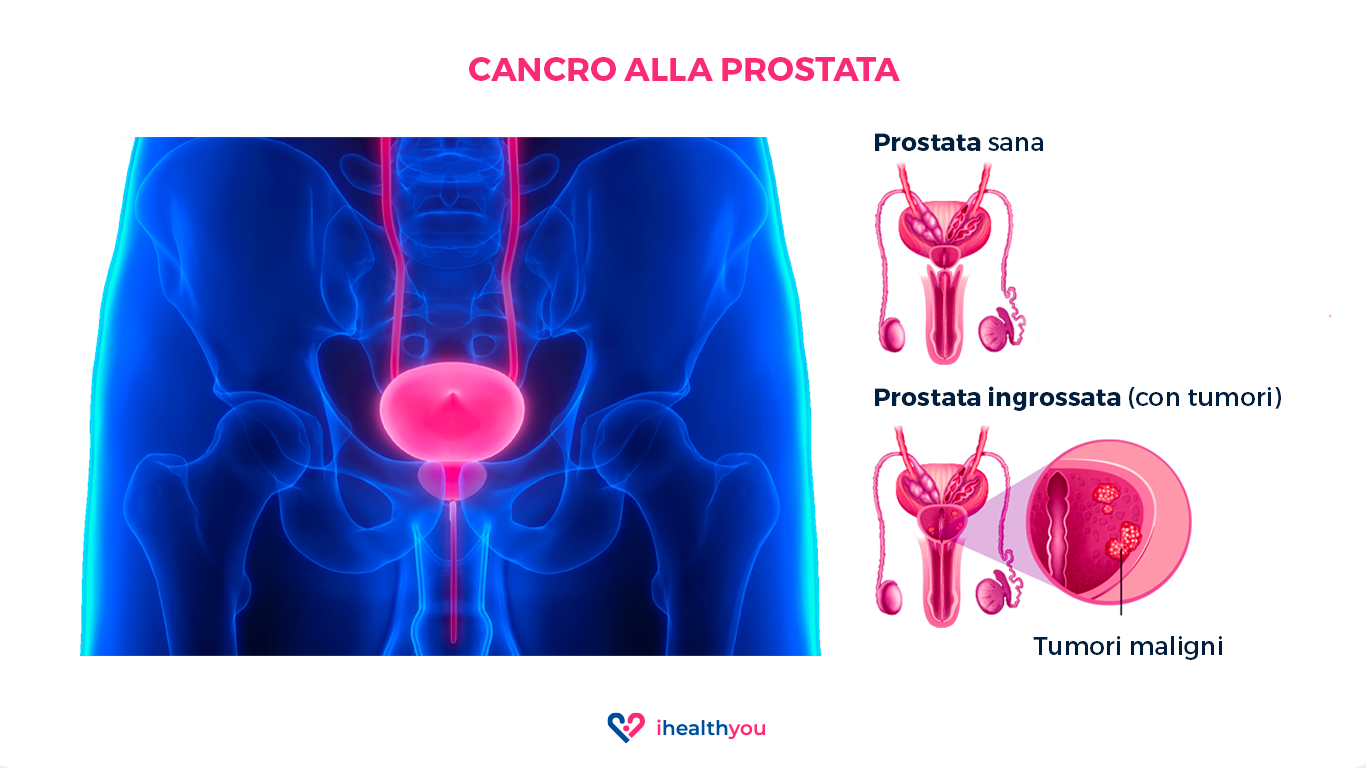 La recidiva del tumore alla prostata dopo radioterapia