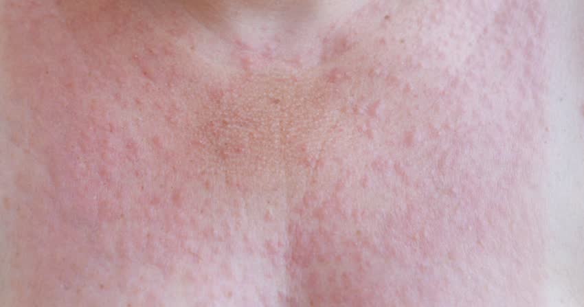 Guida completa all'allergia al sole: dai sintomi ai rimedi