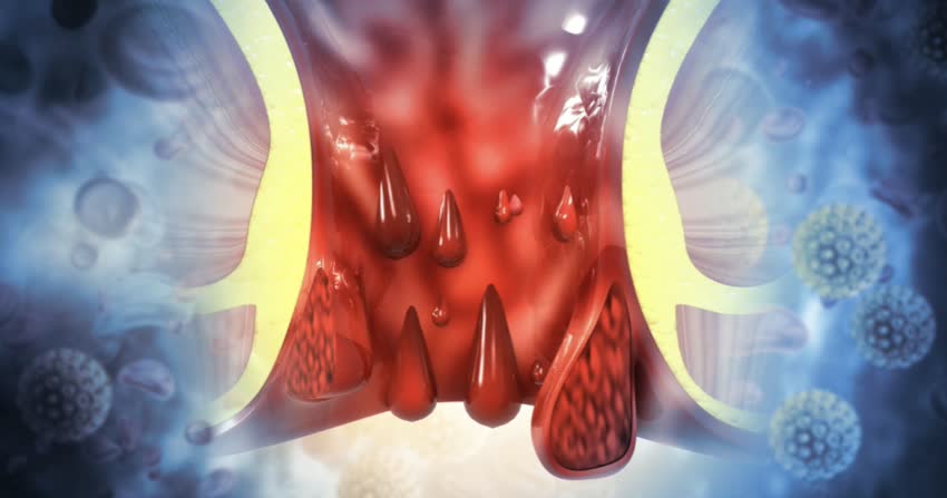 Soffri di emorroidi sanguinanti? Tutto quello che devi sapere