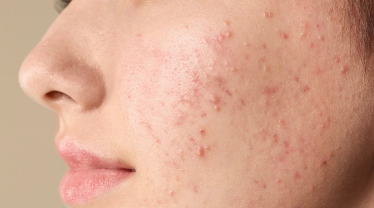 Macchie Rosse sulla Pelle: Cause, Diagnosi e Trattamento