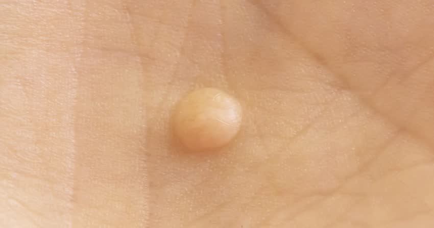 Condilomi: riconoscere i sintomi e agire in tempo