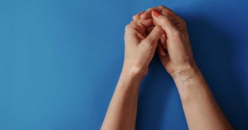 Come inizia la vitiligine: primi sintomi e come riconoscerli